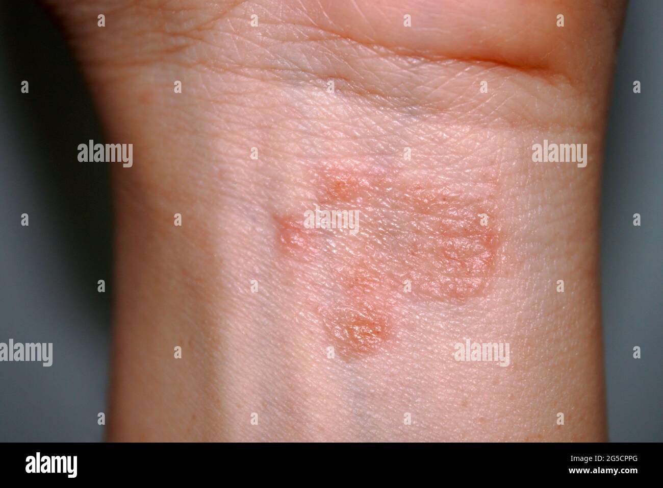 Pityriasis rosea Banque de photographies et d’images à haute résolution ...
