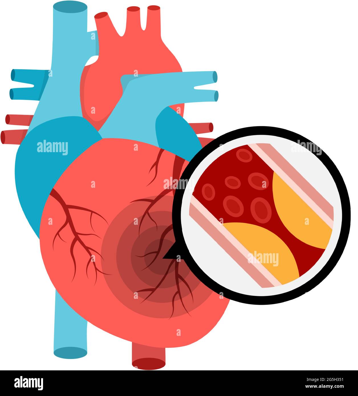 Anatomie cardiaque humaine avec crise cardiaque. Plaque ...