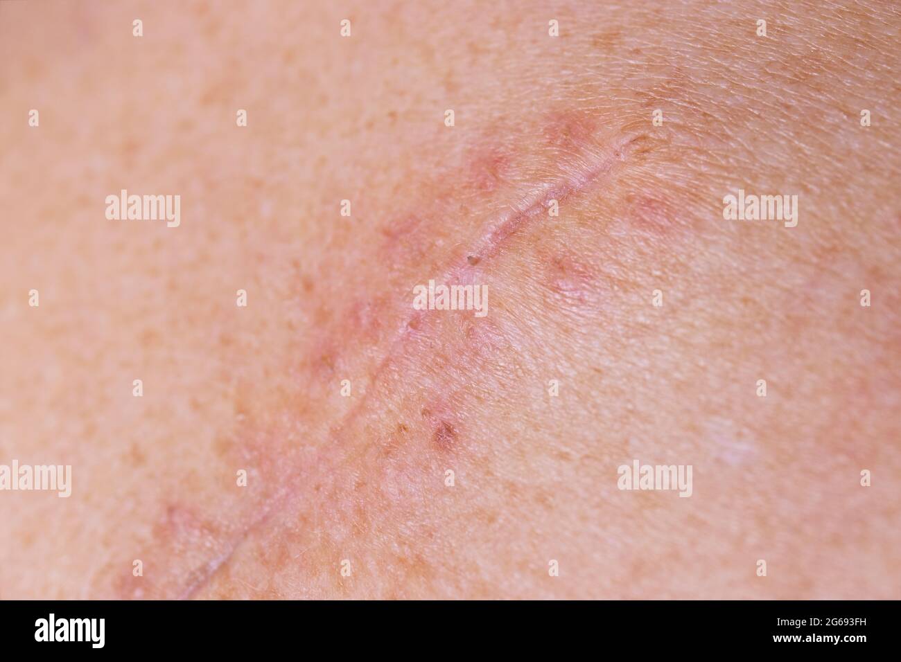 Melanoma scar Banque de photographies et d’images à haute résolution - Alamy