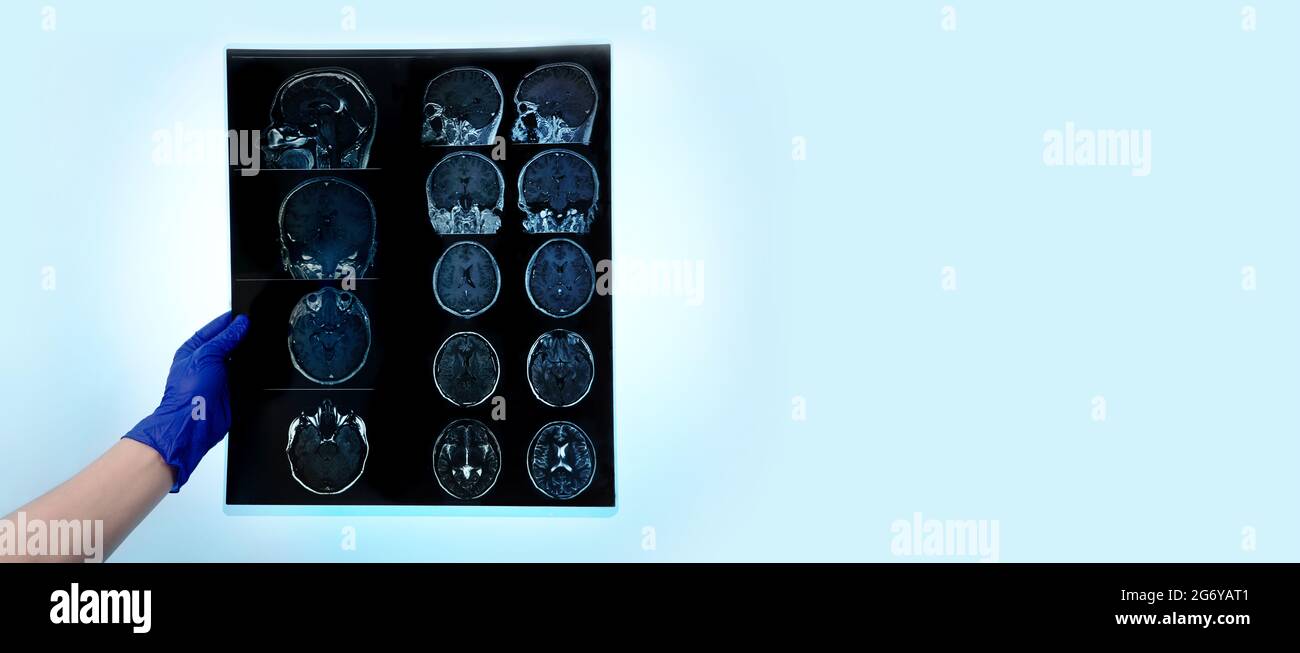 La main dans le gant contient les résultats de l'IRM du cerveau ou de l ...