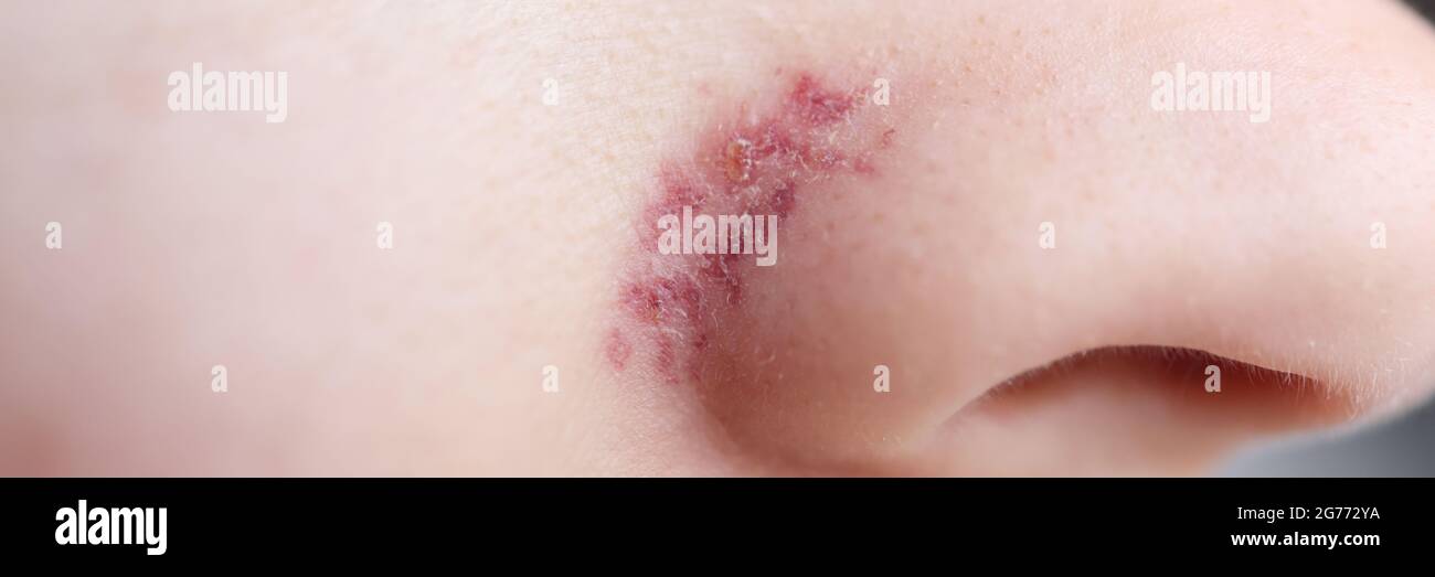 Visage taches veines capillaires Banque de photographies et d’images à ...