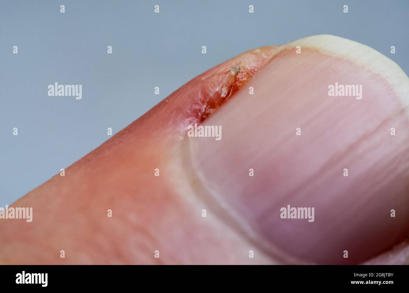Inflammation finger Banque de photographies et d’images à haute ...