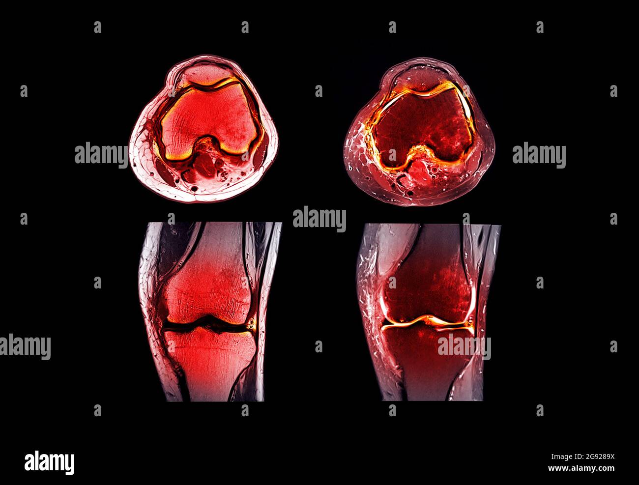 Imagerie par résonance magnétique ou comparaison des articulations du ...