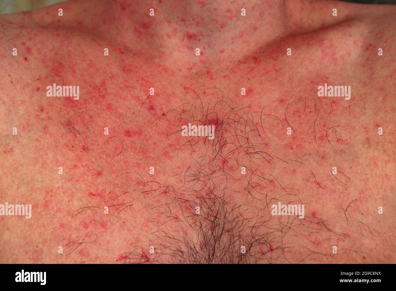 Eruption rouge torse Banque de photographies et d’images à haute ...