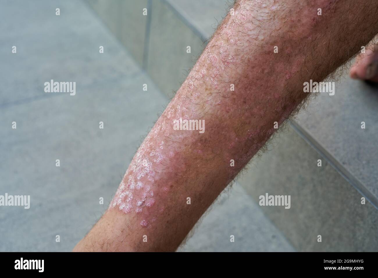 Peau de psoriasis jambe Banque de photographies et d’images à haute ...