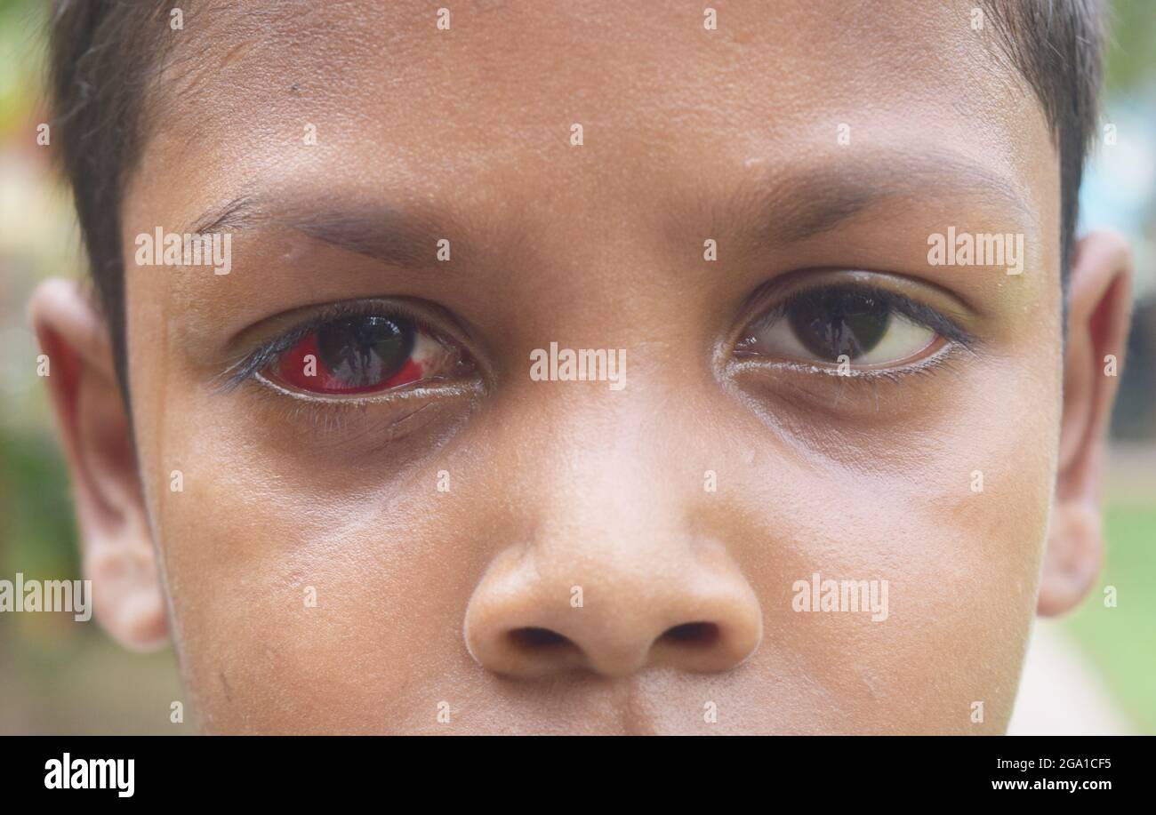 Subconjunctival hemorrhage Banque de photographies et d’images à haute ...