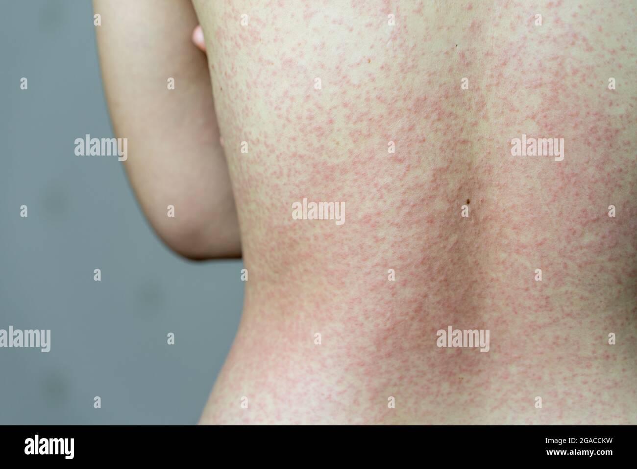 Gros plan de l'éruption cutanée sur le dos de la femme Photo Stock - Alamy