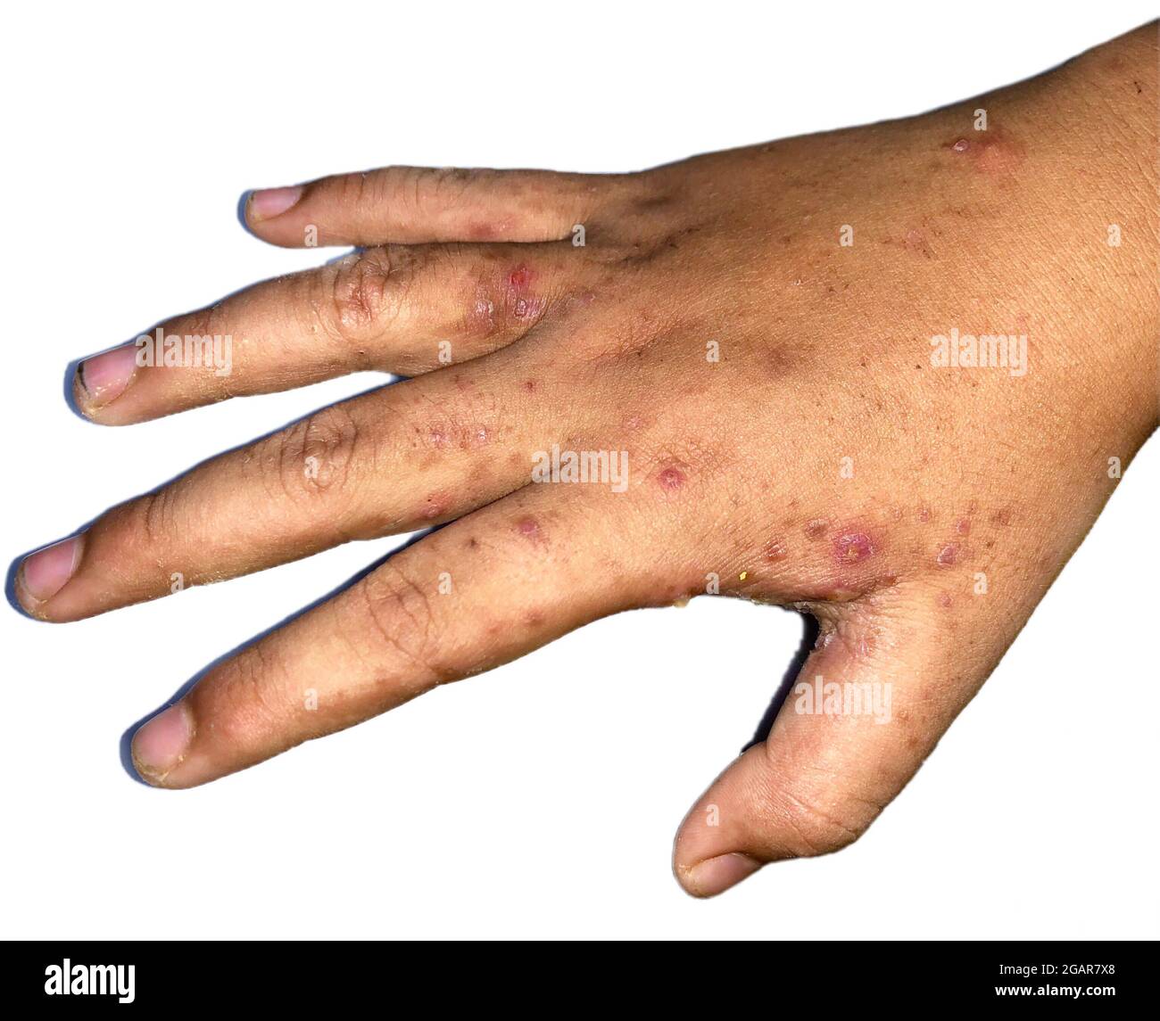 éruption cutanée enfant main Banque d'images détourées - Alamy