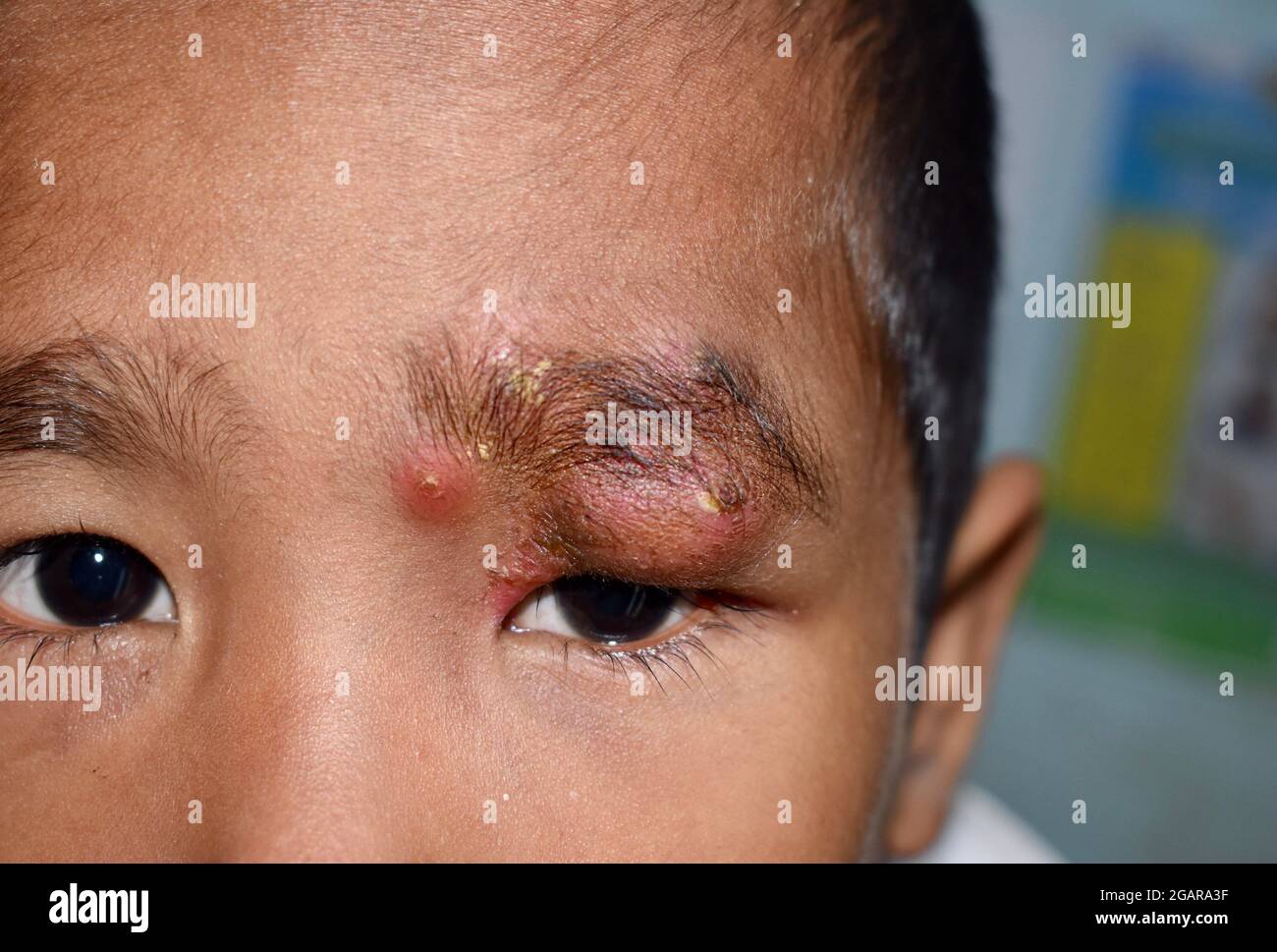 Cellulitis infection Banque de photographies et d’images à haute ...