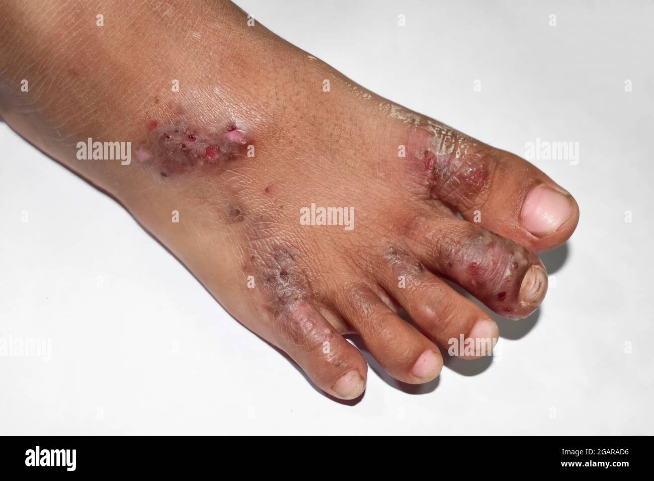 Bacterial infection Banque de photographies et d’images à haute ...