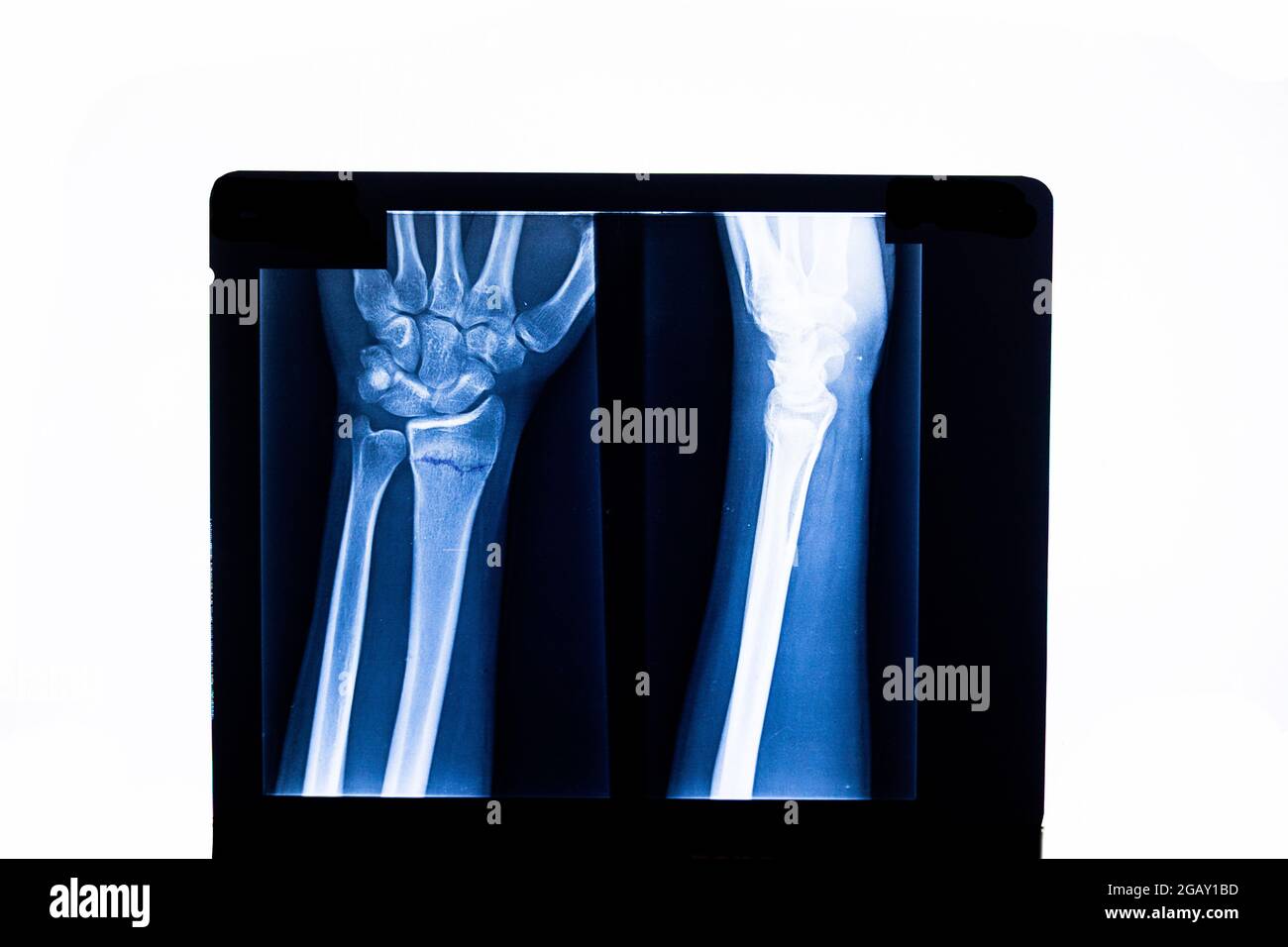 Examen radiographique de la fracture du rayon. Bras humain à rayons X ...