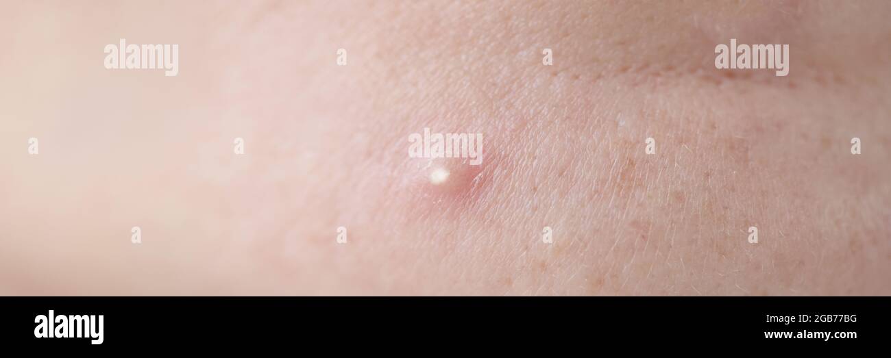 Tache rouge peau visage Banque de photographies et d’images à haute ...
