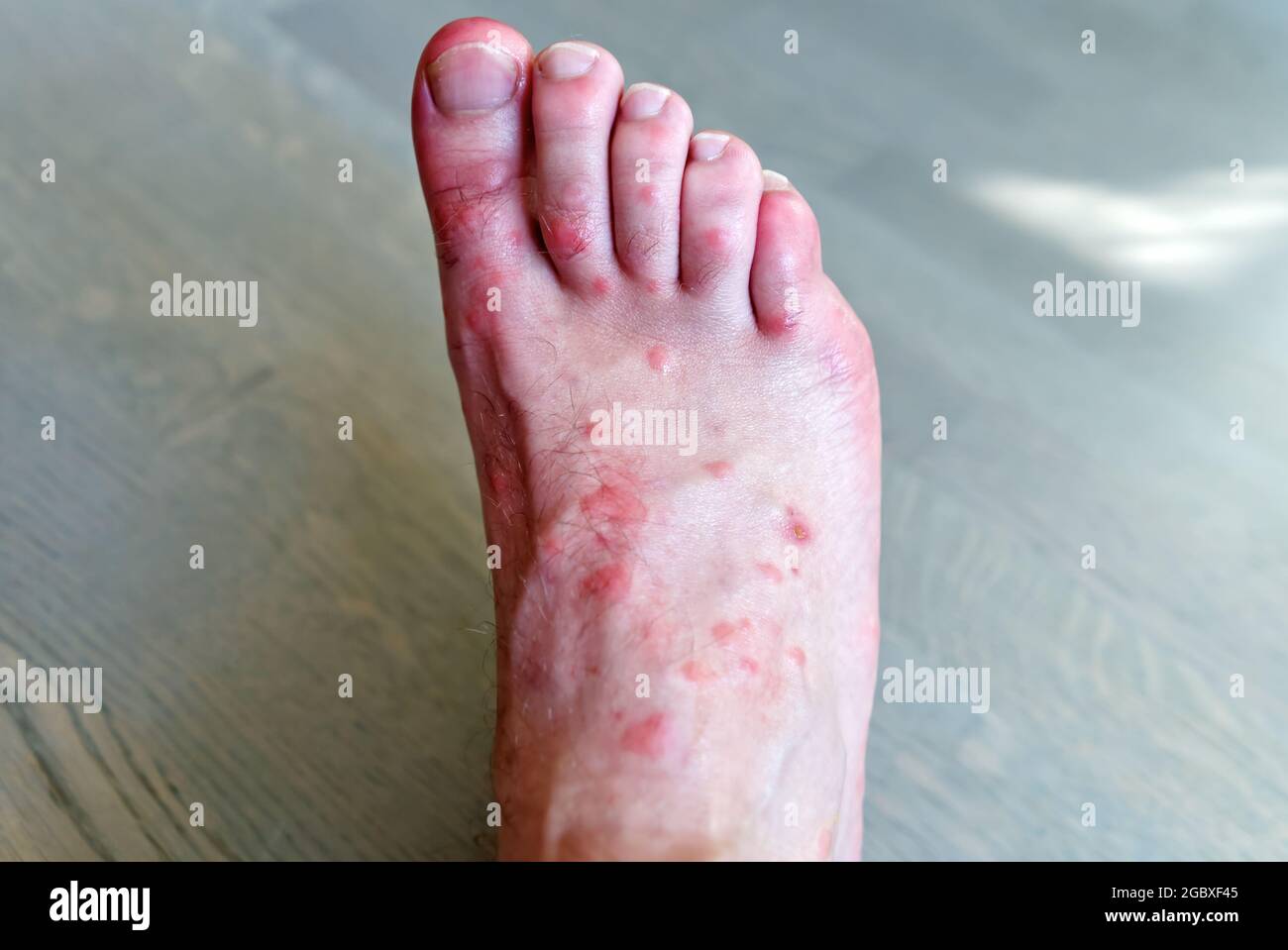 Tache rouge peau sur la jambe Banque de photographies et d’images à ...