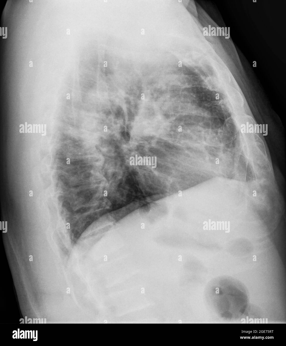 Radiographie thoracique normale Banque de photographies et d’images à ...