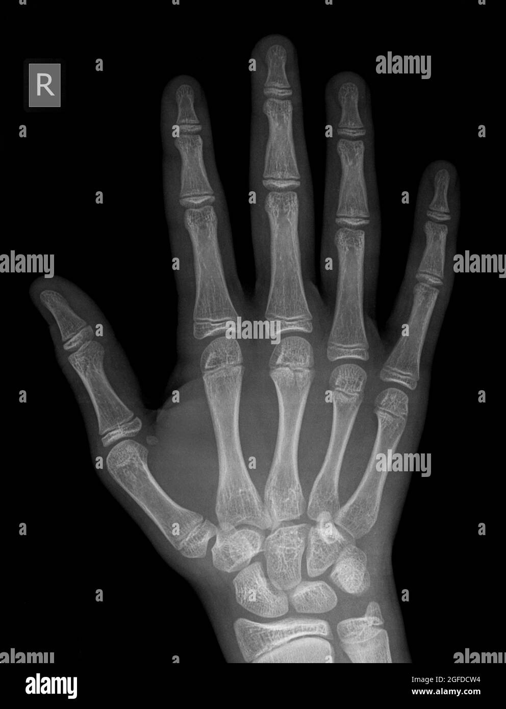 Radiographie d'un poignet fracturé Banque de photographies et d’images ...