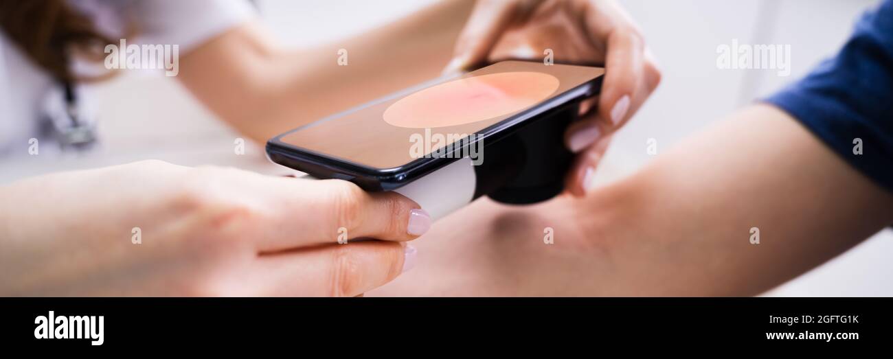 Mélanome cancer de la peau Banque de photographies et d’images à haute résolution - Alamy