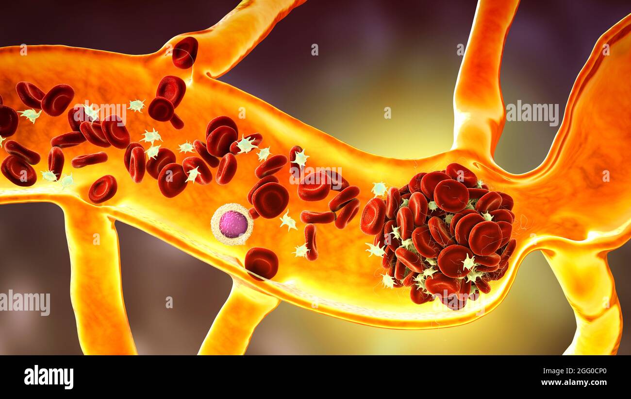 Caillot De Sang Banque d'image et photos - Alamy