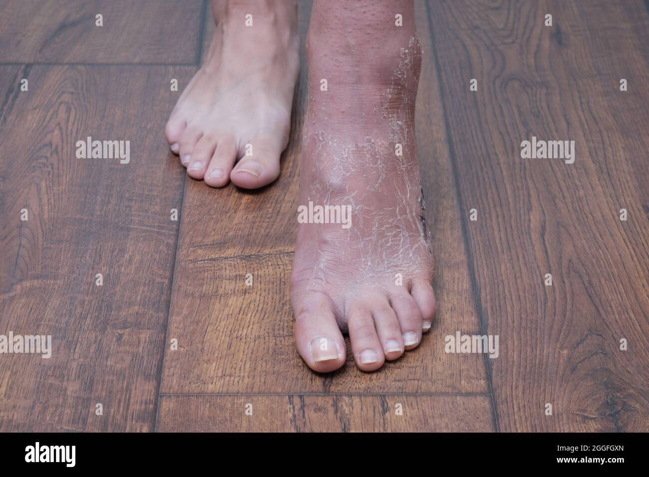 Maladie de peau sur les jambes Banque de photographies et d’images à ...