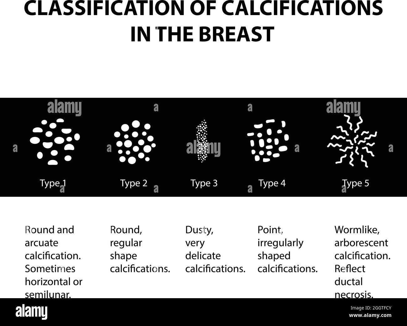 classification-des-calcifications-dans-la-glande-mammaire-mammographie