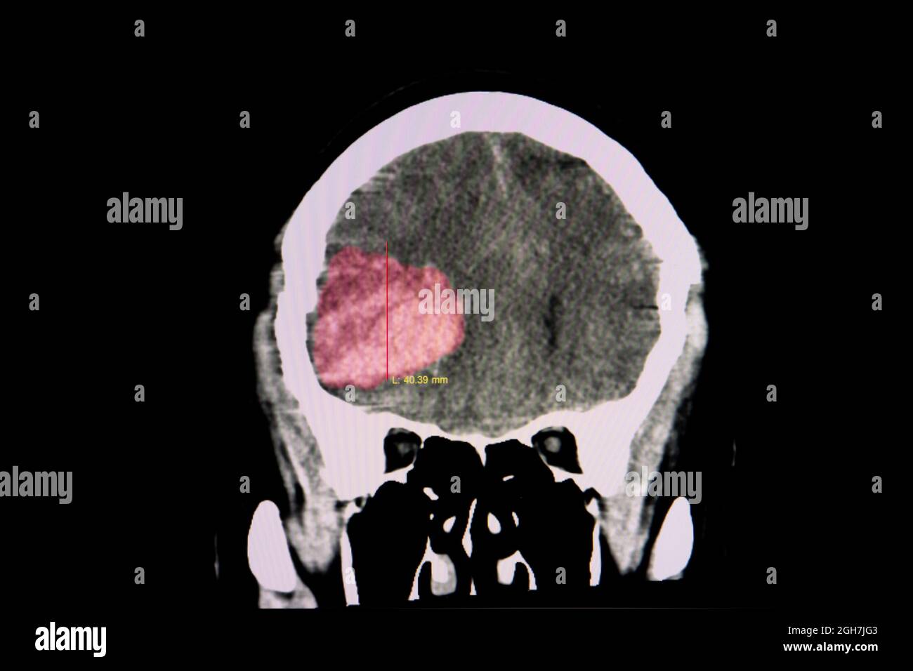 Scanner le cerveau d'un patient thrombocytopénique avec un gros caillot ...