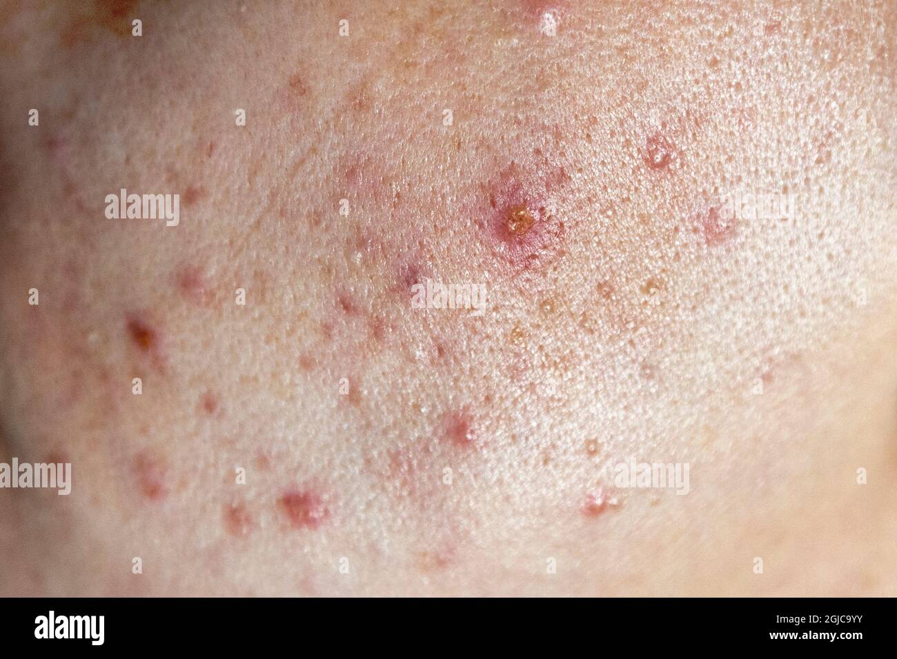 Tache rouge peau visage Banque de photographies et d’images à haute ...