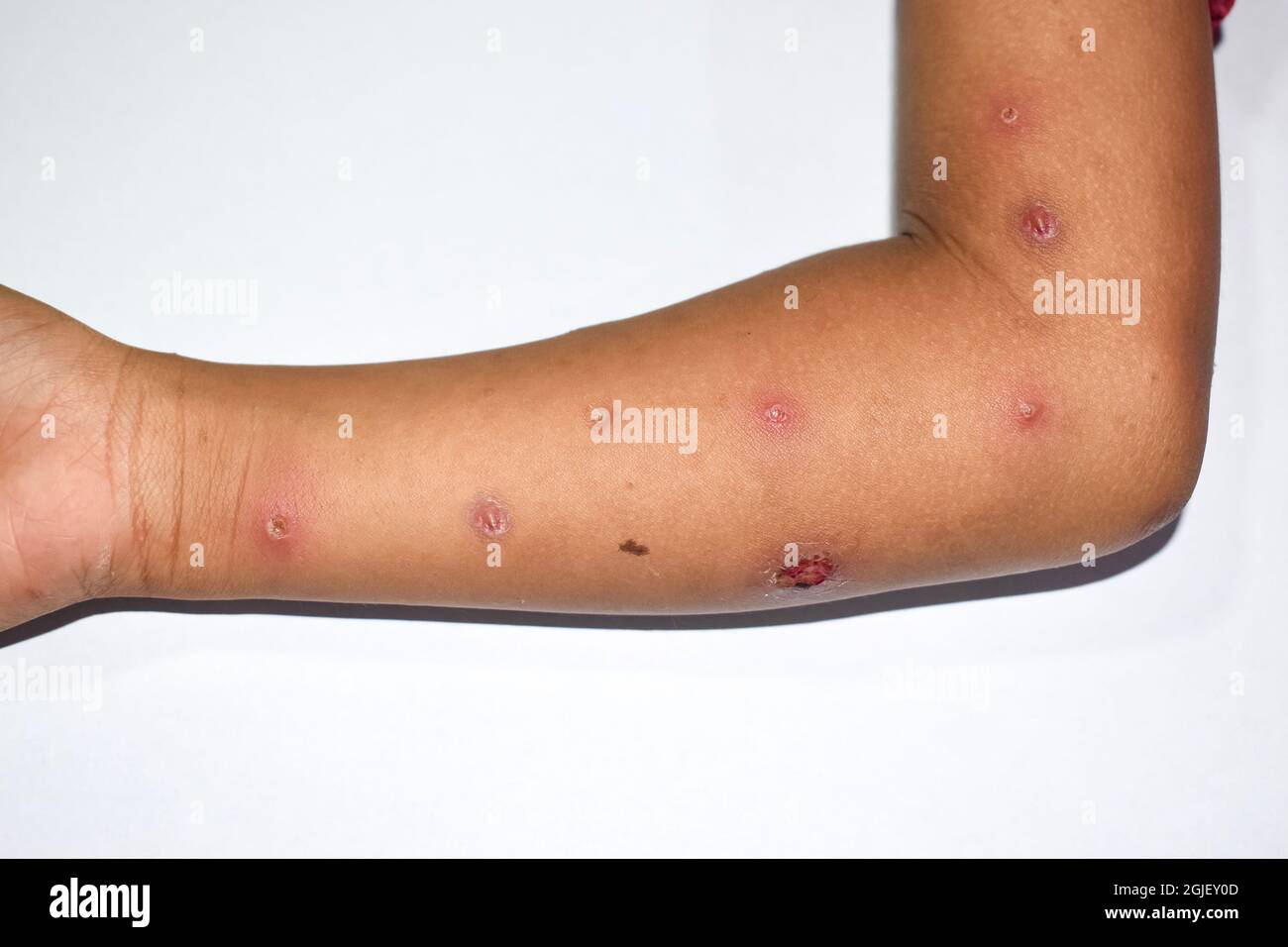 La gale boutons Banque de photographies et d’images à haute résolution ...