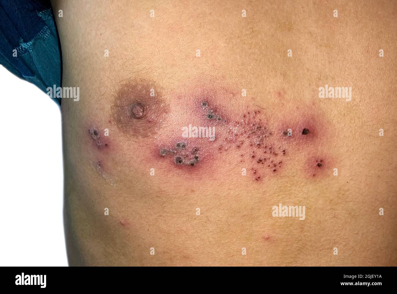 Herpes simplex lesions Banque de photographies et d’images à haute ...