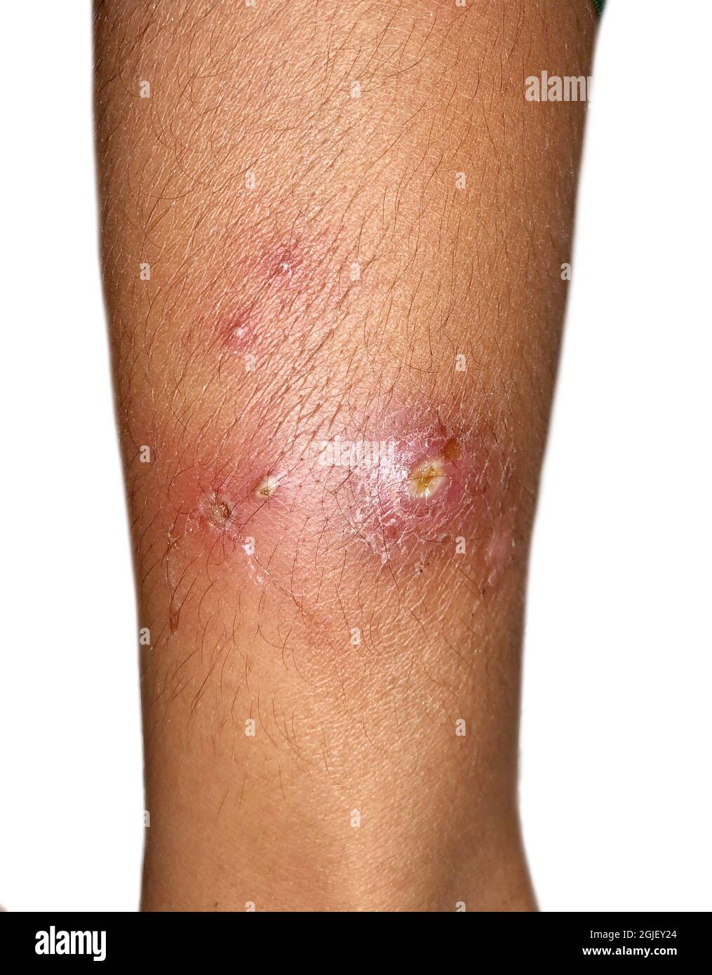 Cellulitis leg infection Banque de photographies et d’images à haute ...