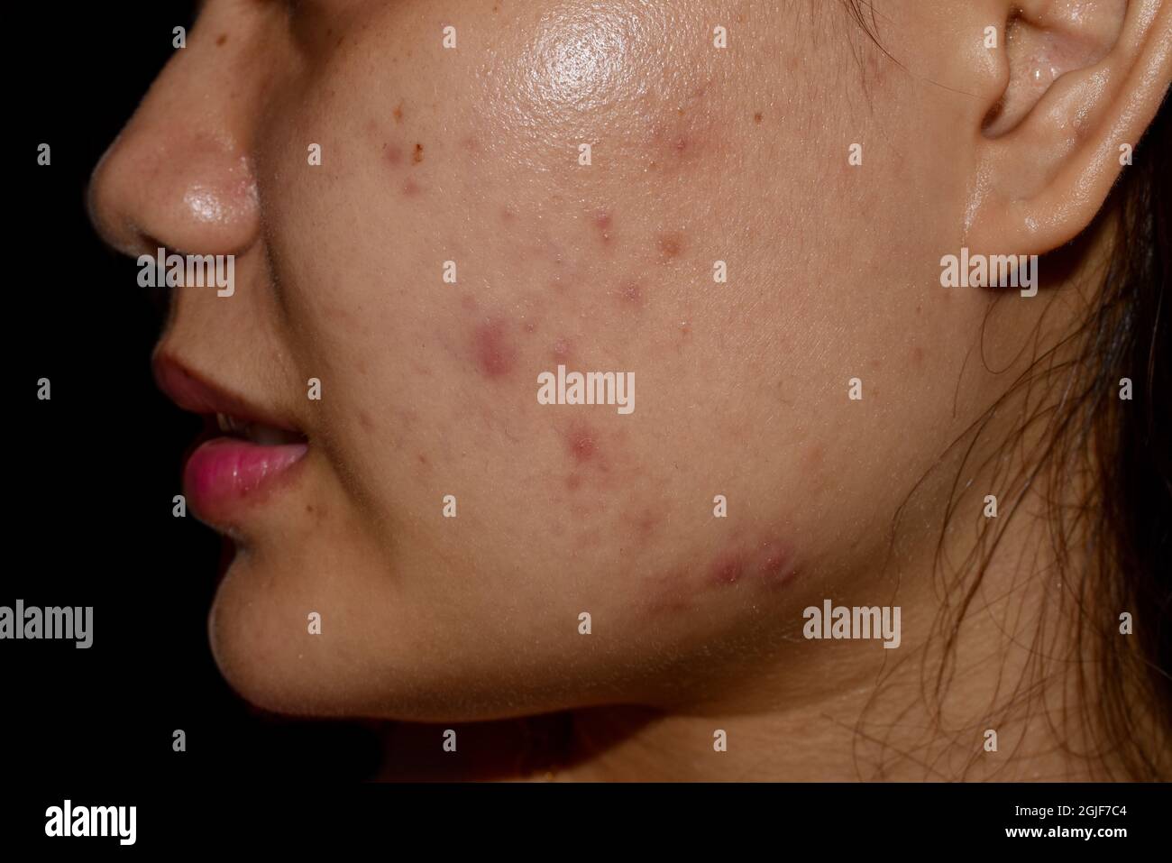 Acné vulgaris, taches noires et cicatrices sur le visage de la jeune femme asiatique. Vue en ...