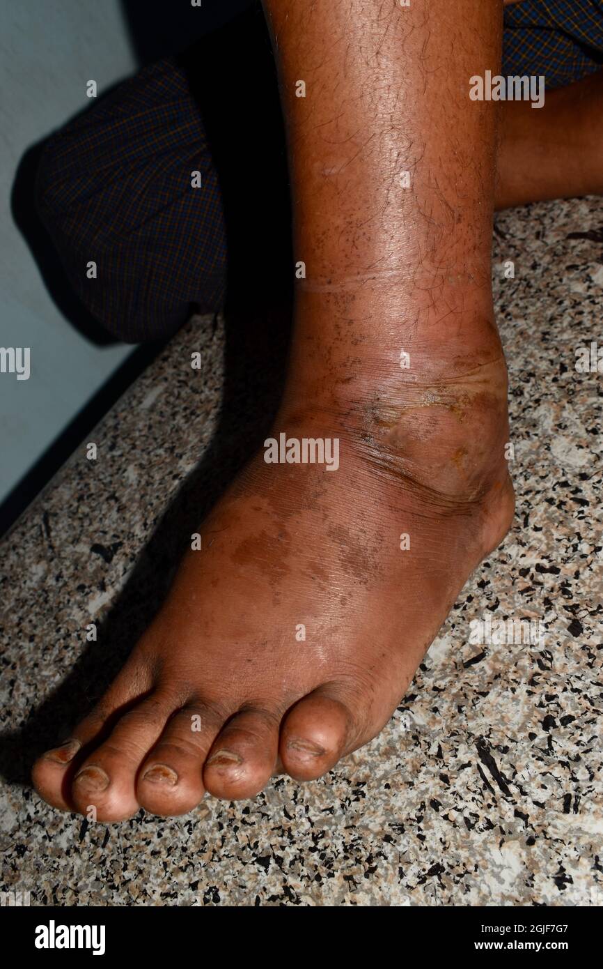 éruptions cutanées aux jambes Banque de photographies et d’images à ...