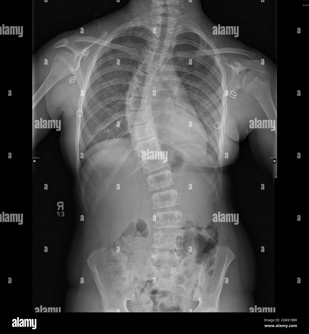 Radiographie préopératoire de la courbure de la colonne vertébrale chez ...