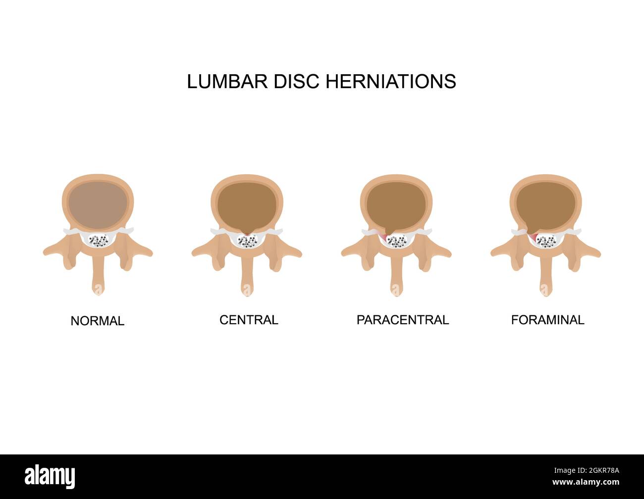 Disk herniation lumbar spine Banque d'images vectorielles - Alamy