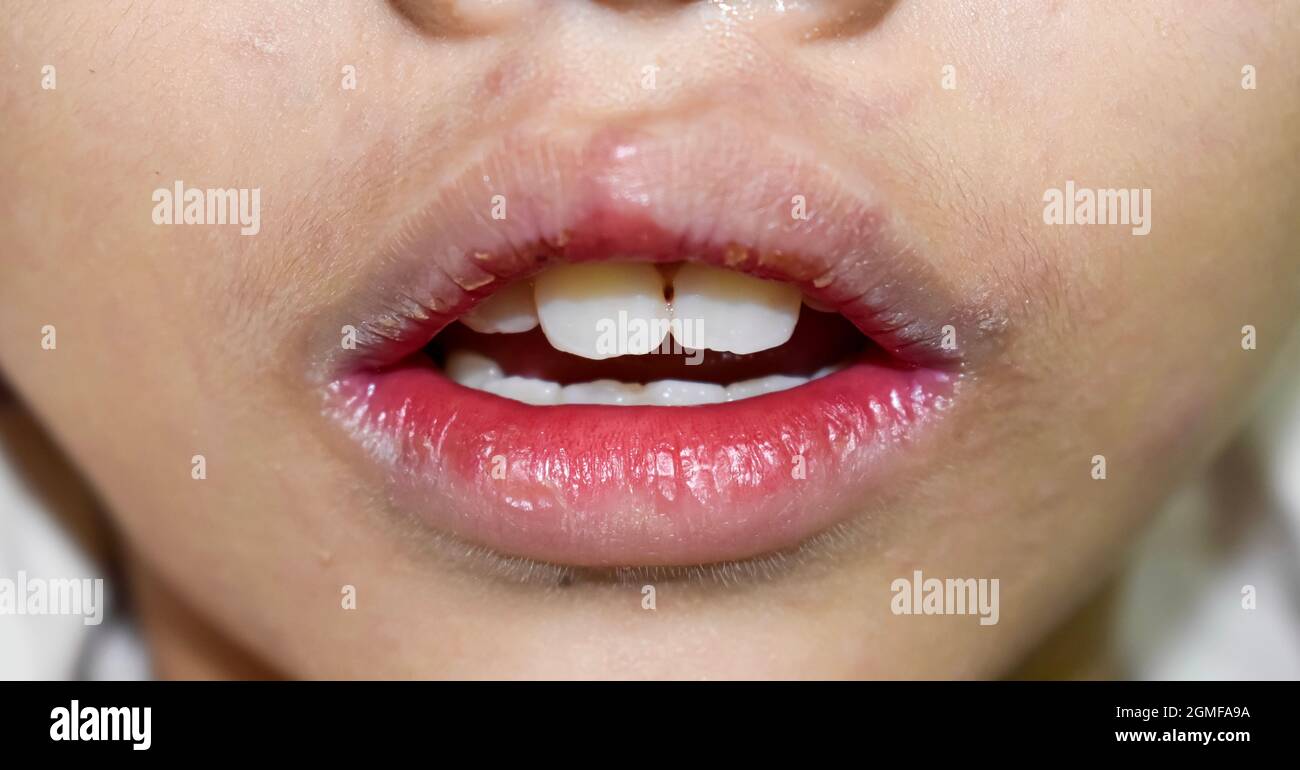 Stomatite angulaire ou chéilite angulaire ou perleche chez le petit ...