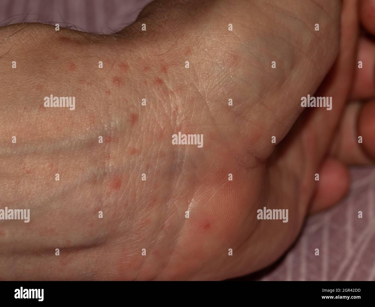 éruption de scarlatine enfant Banque de photographies et d’images à ...