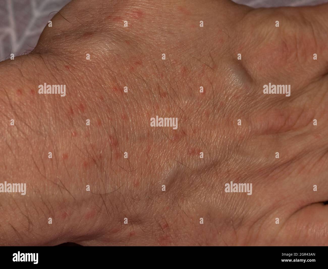 Maladie de la scarlatine Banque de photographies et d’images à haute ...