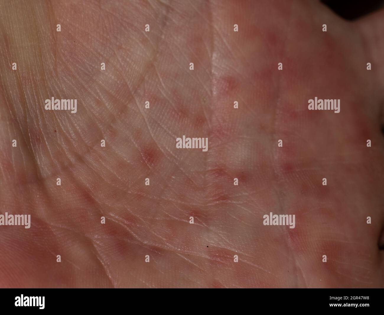 éruption de scarlatine enfant Banque de photographies et d’images à ...