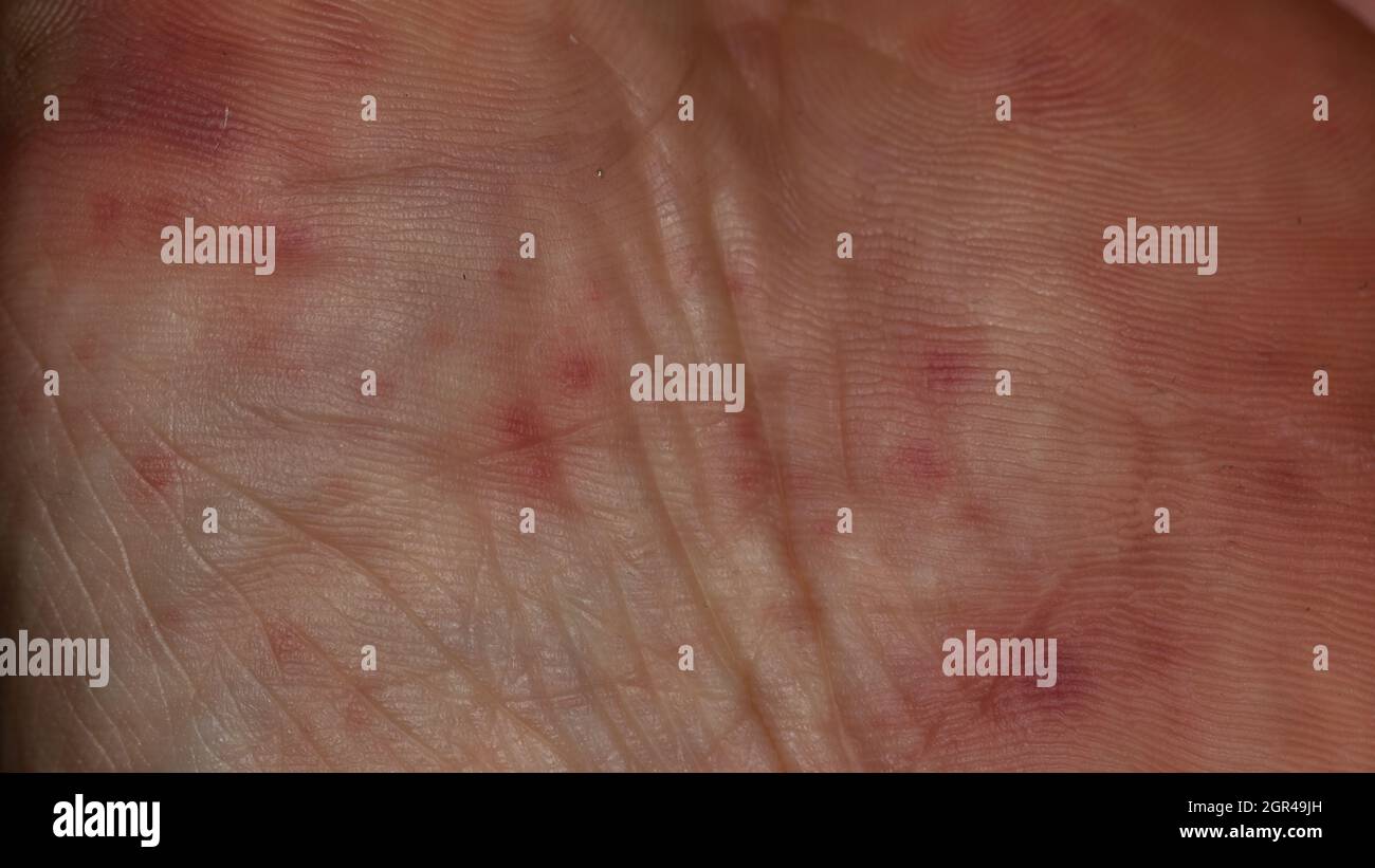 éruption de scarlatine adulte Banque de photographies et d’images à ...