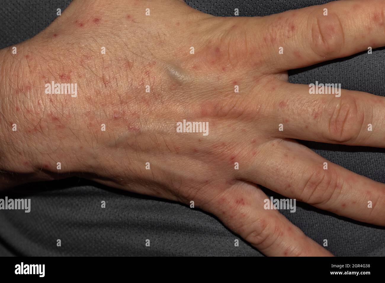 éruption de scarlatine Banque de photographies et d’images à haute ...