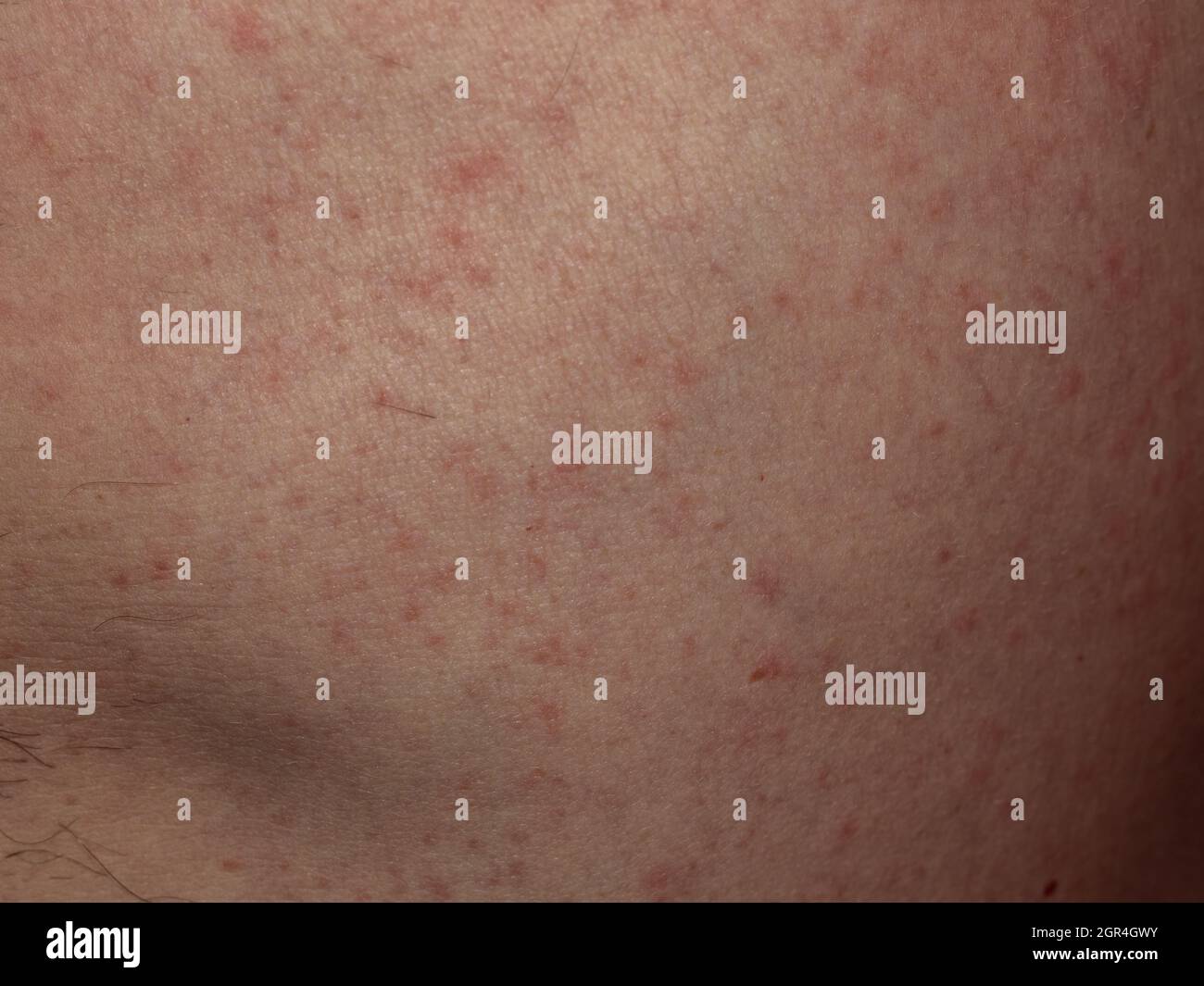 Marques sur la peau Banque de photographies et d’images à haute ...