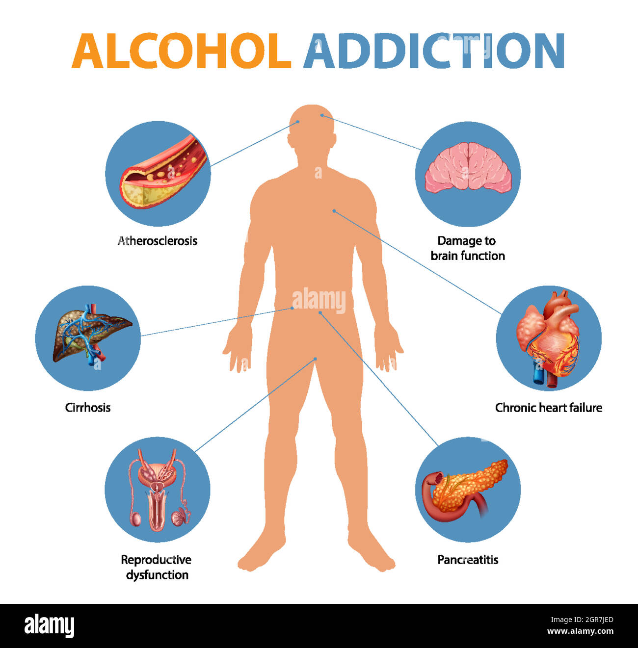 Infographie sur les symptômes de la maladie d'Addison Image Vectorielle ...