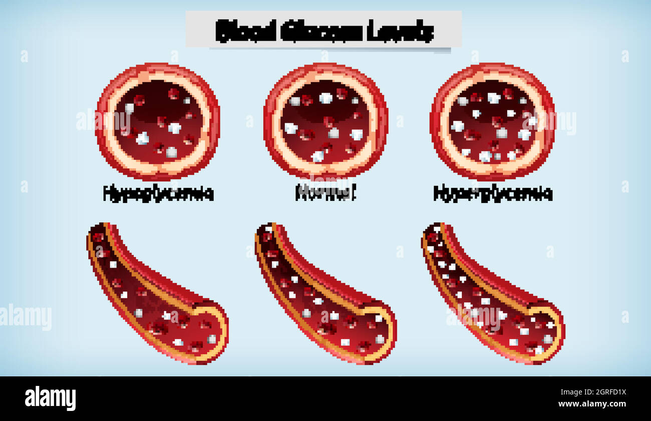 Taux de glucose élevé Banque d'images vectorielles - Alamy