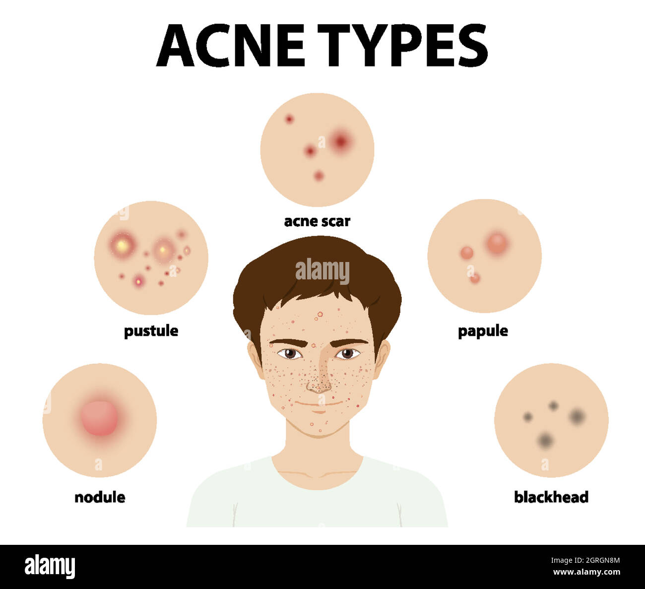 Types d'acné sur la peau ou les boutons Image Vectorielle Stock - Alamy