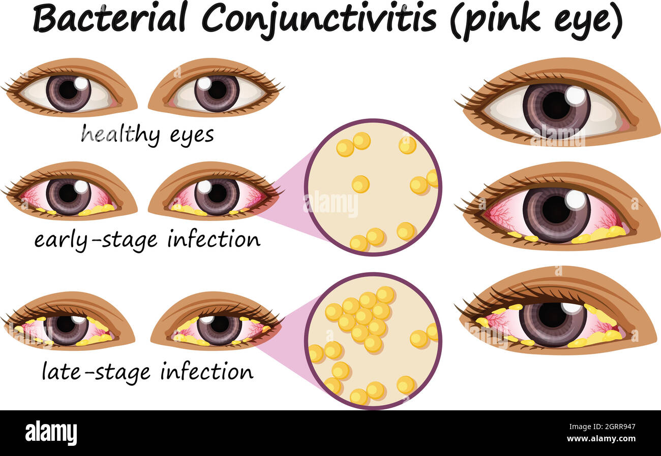Conjonctivite oculaire Banque d'images vectorielles - Alamy