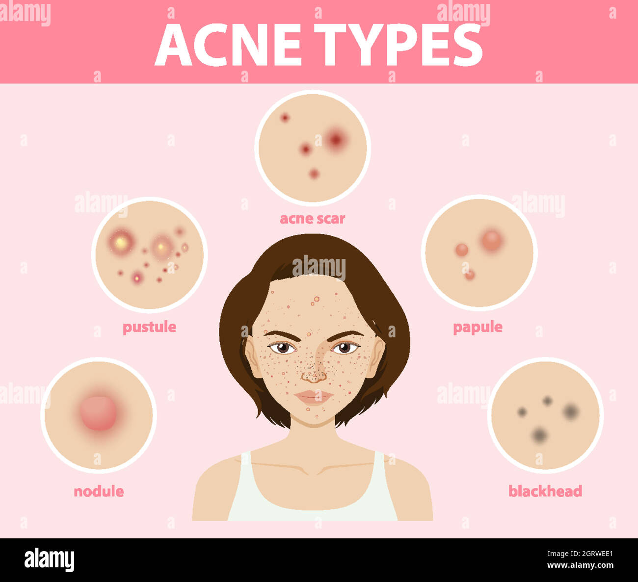 Types d'acné sur la peau ou les boutons Image Vectorielle Stock - Alamy