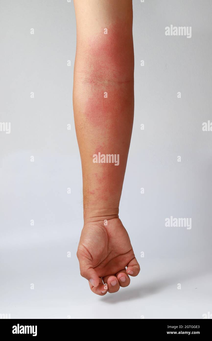 Maladie de peau de la main Banque de photographies et d’images à haute ...