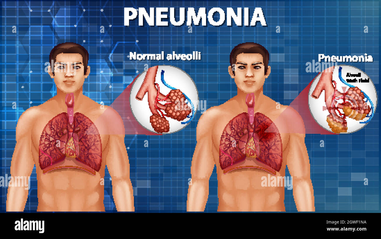 Pneumonia lung drawing Banque de photographies et d’images à haute ...