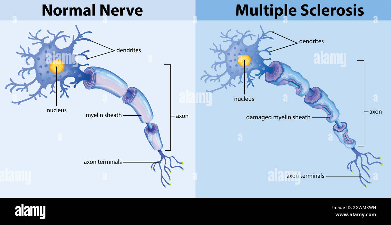 Dessin de nerf Banque de photographies et d’images à haute résolution ...