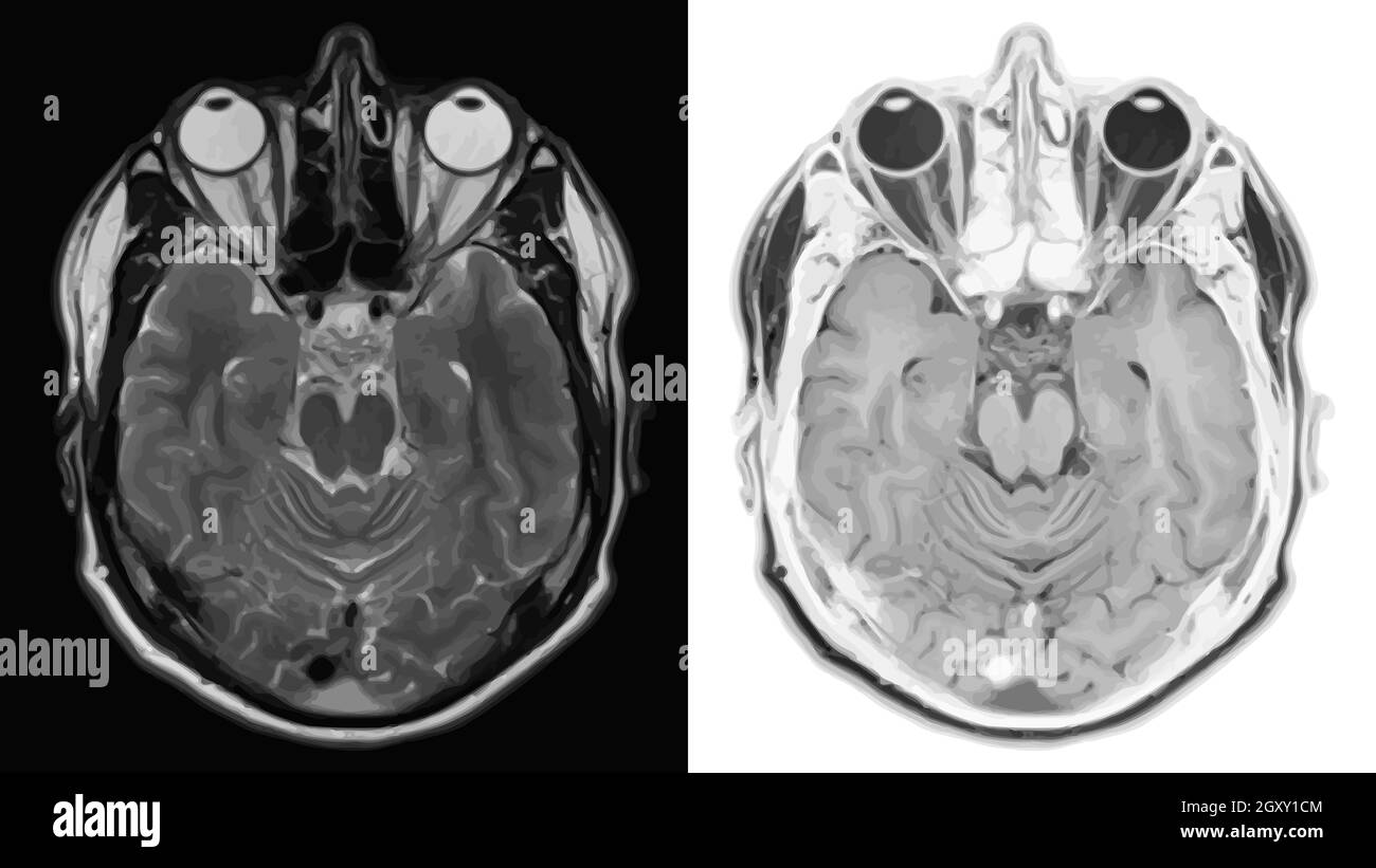 Coupe transversale réaliste du cerveau avec scanner, IRM imagerie par ...