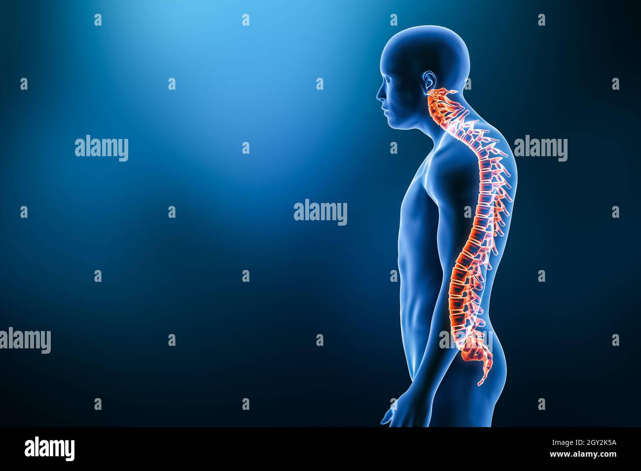 Pathologie de cyphose avec modèle MAN à partir d'une vue latérale ...