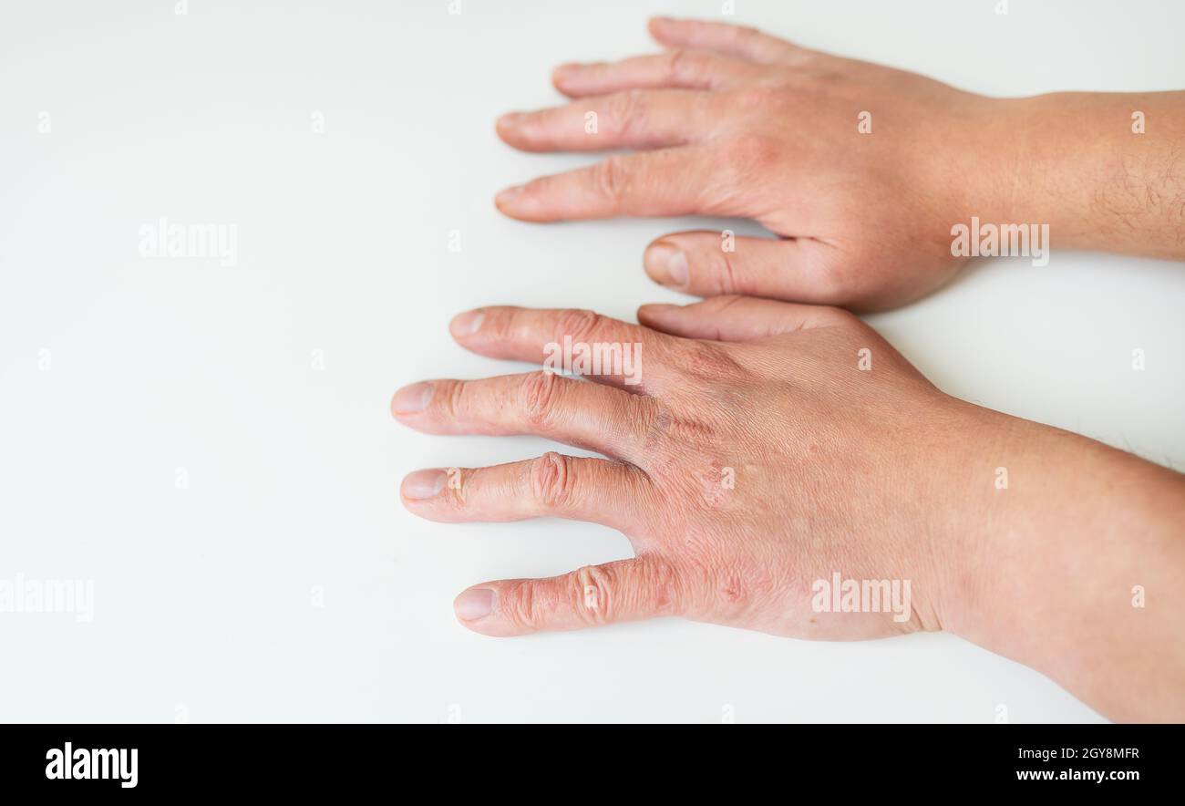 Skin rash eczema on hands Banque de photographies et d’images à haute ...